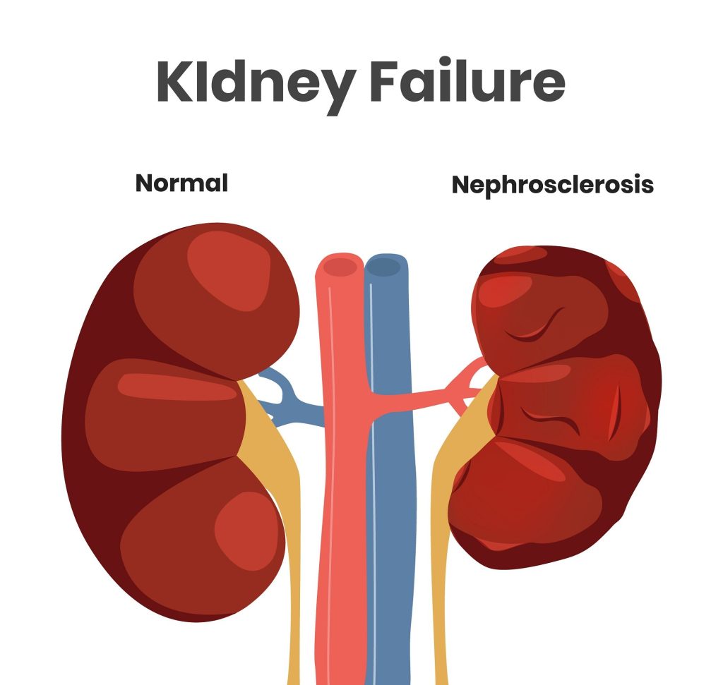 Dialysis - Types, Effectiveness, Side Effects